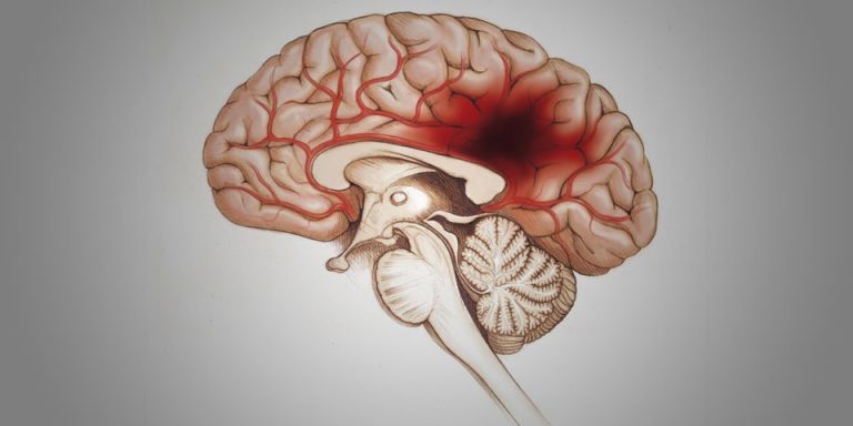ACV: diagnóstico y tratamiento actualizado | Fucac